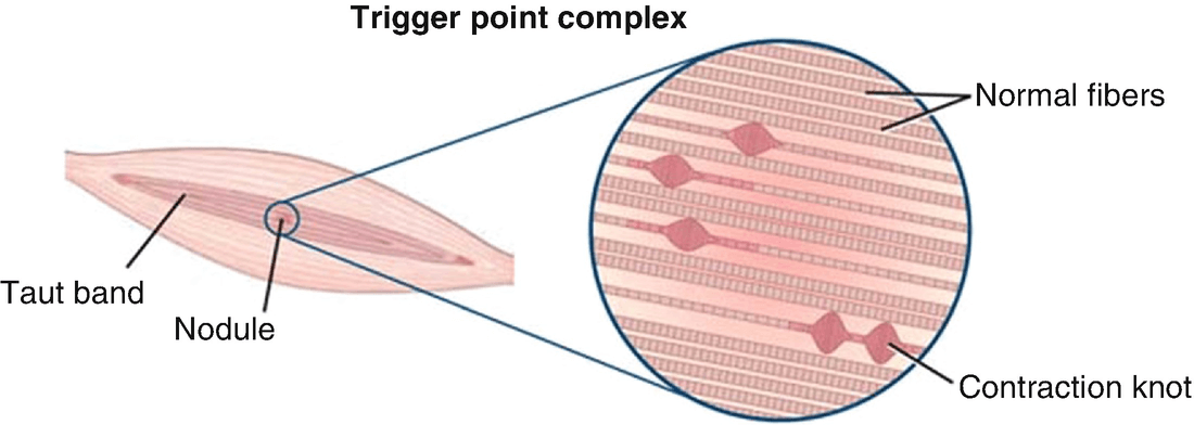 Understanding Trigger Points and How Physical Therapists Can Help - Respire Physical Therapy